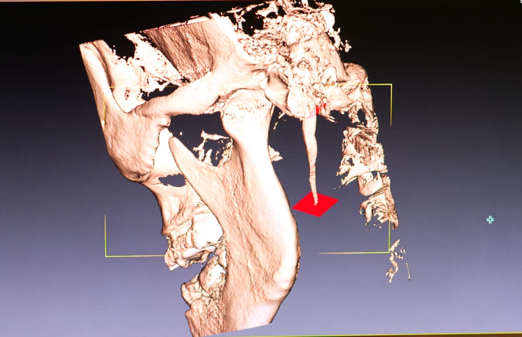 Parafunctional Habits/TMJ Dysfunction - Pro Oral Family Dentistry LTD