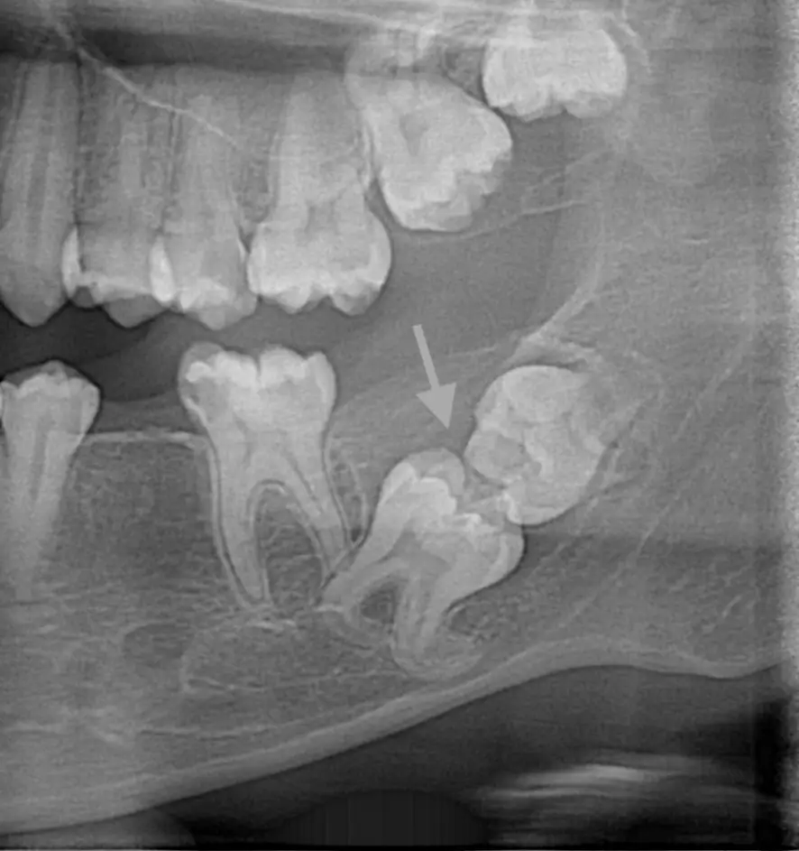 Kissing Molars in Dentistry: A Brief Overview - Pro Oral Family ...